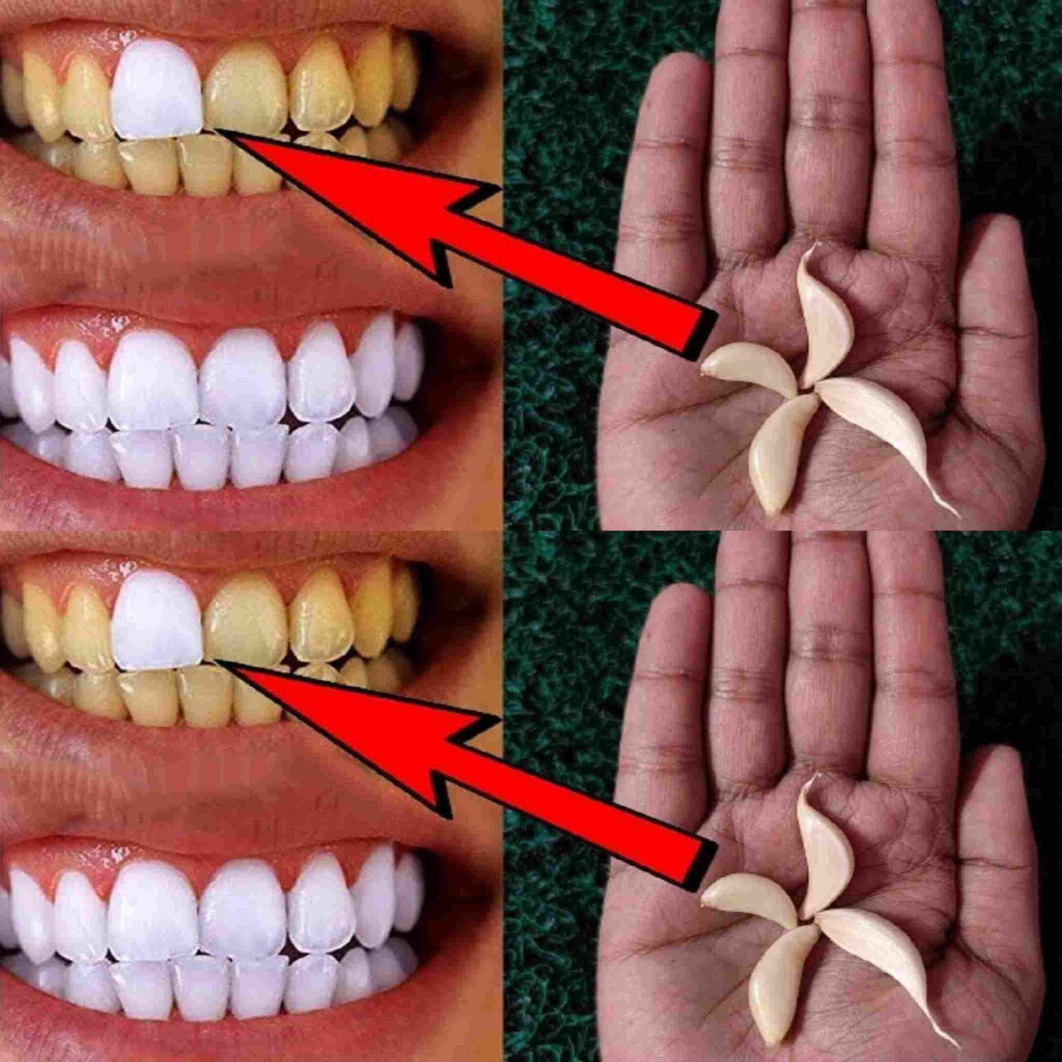 Valkosipuli: vähän tunnettu salaisuus luonnollisen kirkkaaseen hymyyn ...